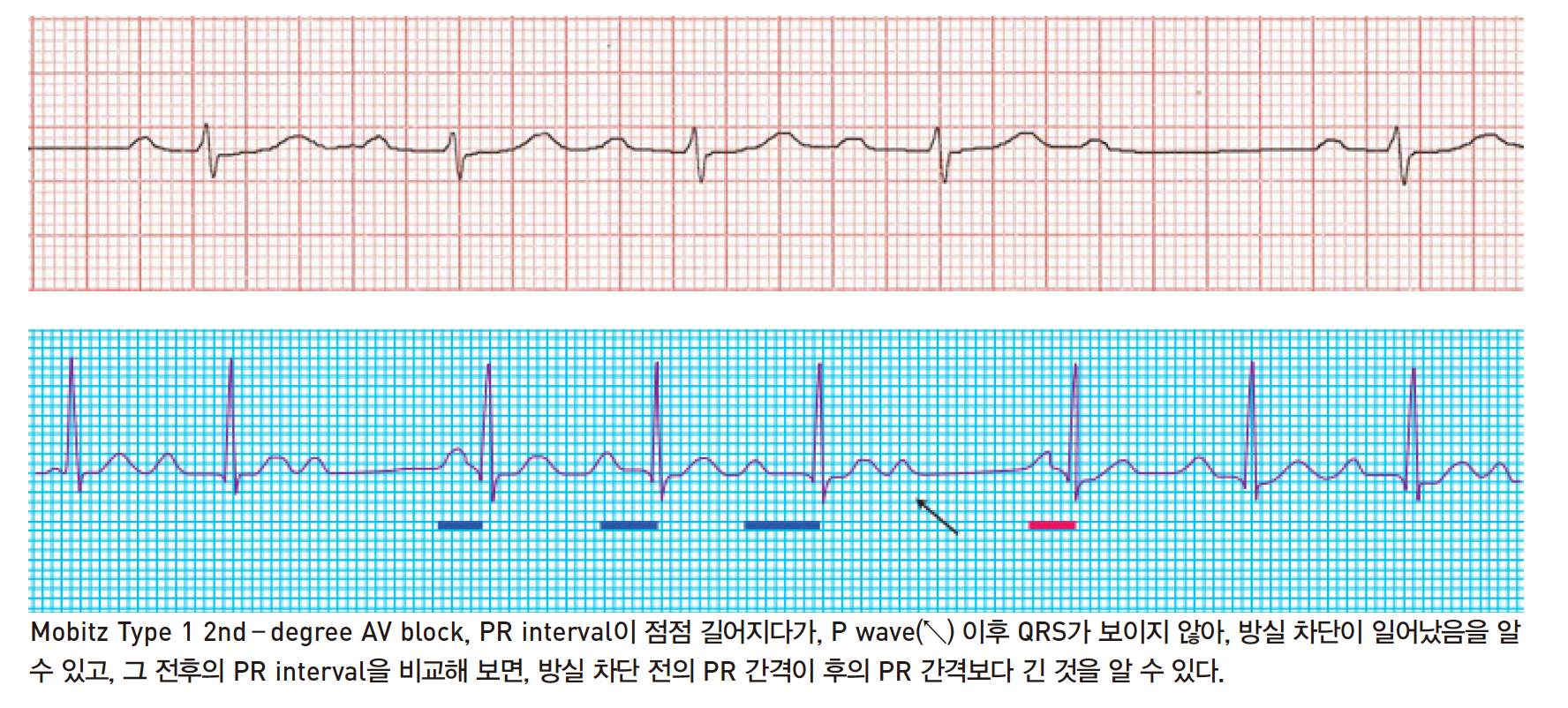 서맥 부정맥 - Metamedic