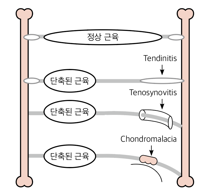 주사치료: IMS(Intramuscular Stimulation) - Metamedic