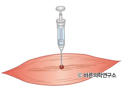 주사치료: TPI(Trigger point injection, 통증 유발점 주사) - Metamedic