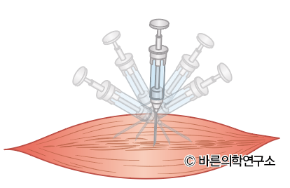 주사치료: TPI(Trigger point injection, 통증 유발점 주사) - Metamedic