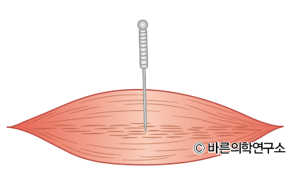 주사치료: TPI(Trigger point injection, 통증 유발점 주사) - Metamedic