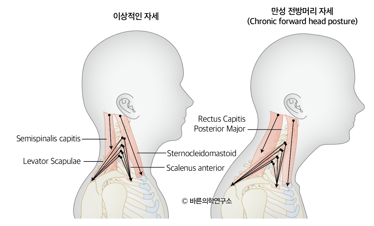 거북목/일자목 증후군(Turtle neck/flat neck syndrome) - Metamedic