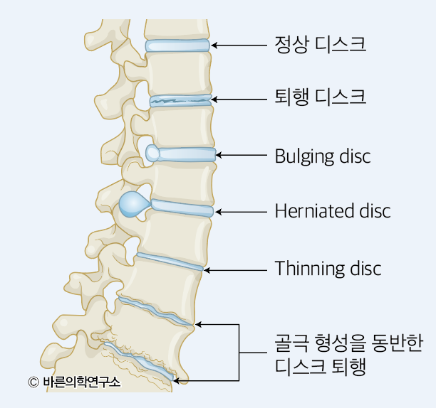 요추디스크질환(Lumbar disk disease) - Metamedic