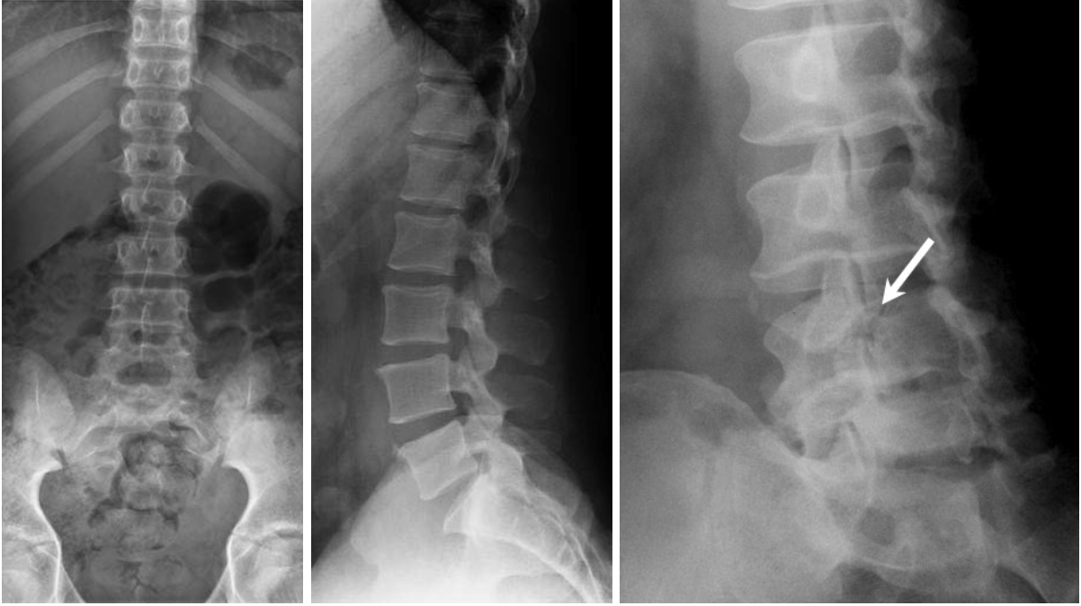 요추부수핵탈출증(Lumbar HNP) - Metamedic