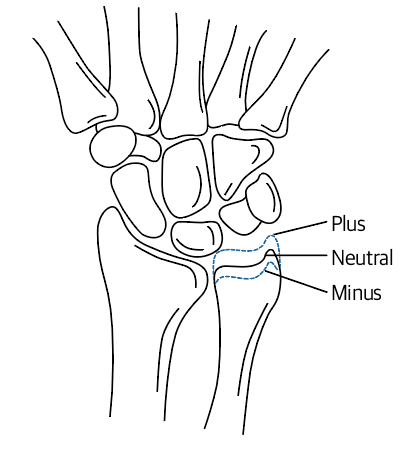 월상골 무혈 괴사(lunate avascular necrosis)=Kienbock 병 - Metamedic