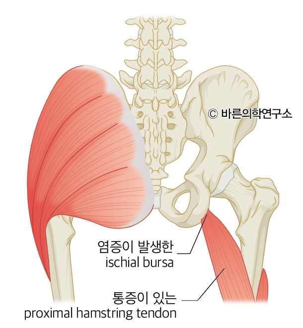 고관절 윤활낭염(Hip bursitis) - Metamedic