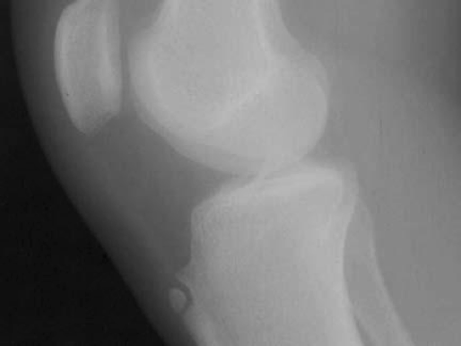 오스구스씨 병(Osgood-Schlatter disease, Tibial apophysitis) - Metamedic