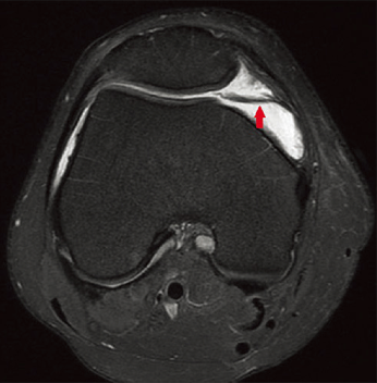 활막 추벽 증후군(Synovial plica syndrome, medial plica syndrome) - Metamedic