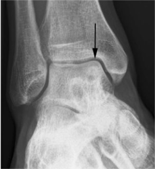 거골의 골연골 병변(골연골골절, Osteochondral lesion of talus, OLT) - Metamedic