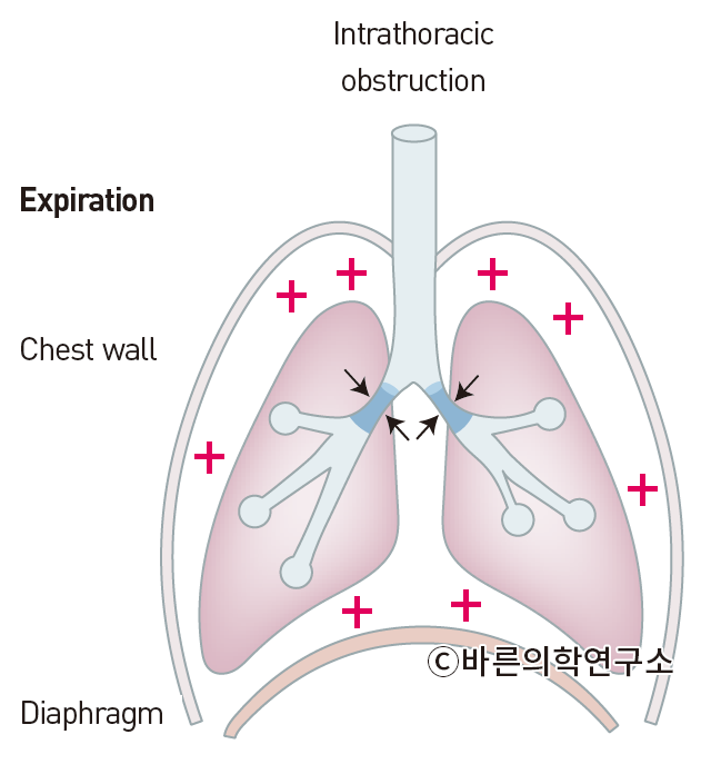 폐기능검사 - Metamedic