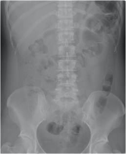 복부 X선 - Metamedic