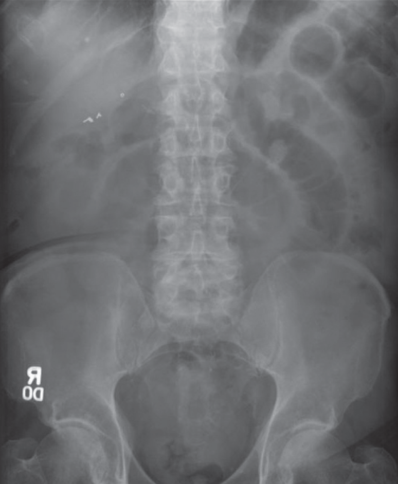 복부 X선 - Metamedic