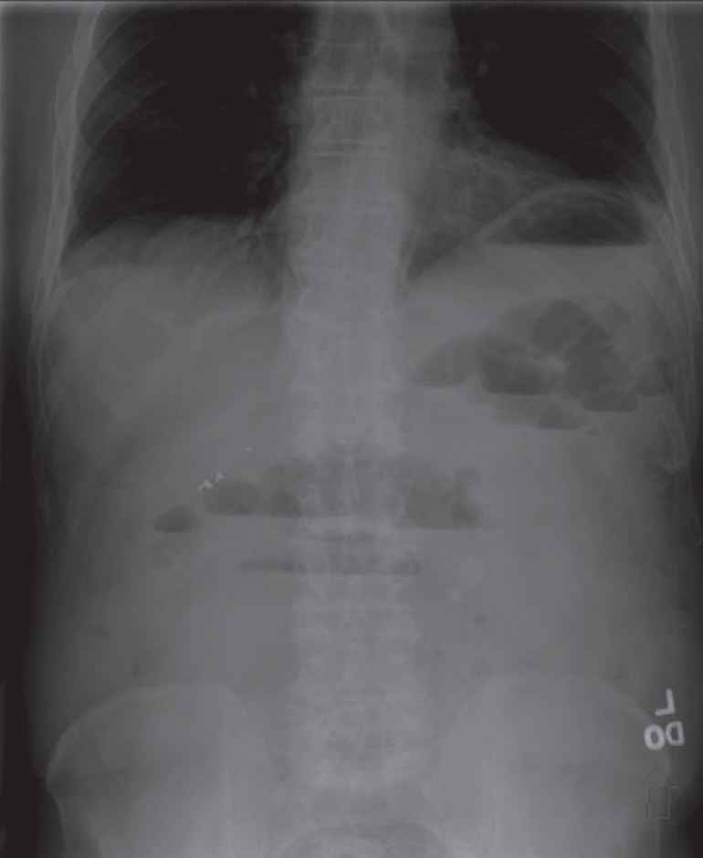 복부 X선 - Metamedic