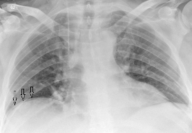 복부 X선 - Metamedic