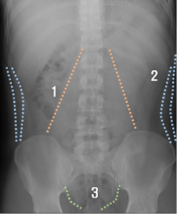 복부 X선 - Metamedic