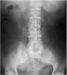 복부 X선 - Metamedic