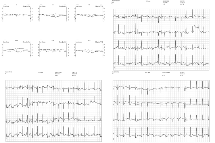 허혈성 심질환: 안정형 허혈성 심질환 (Stable ischemic heart disease, SIHD) - Metamedic