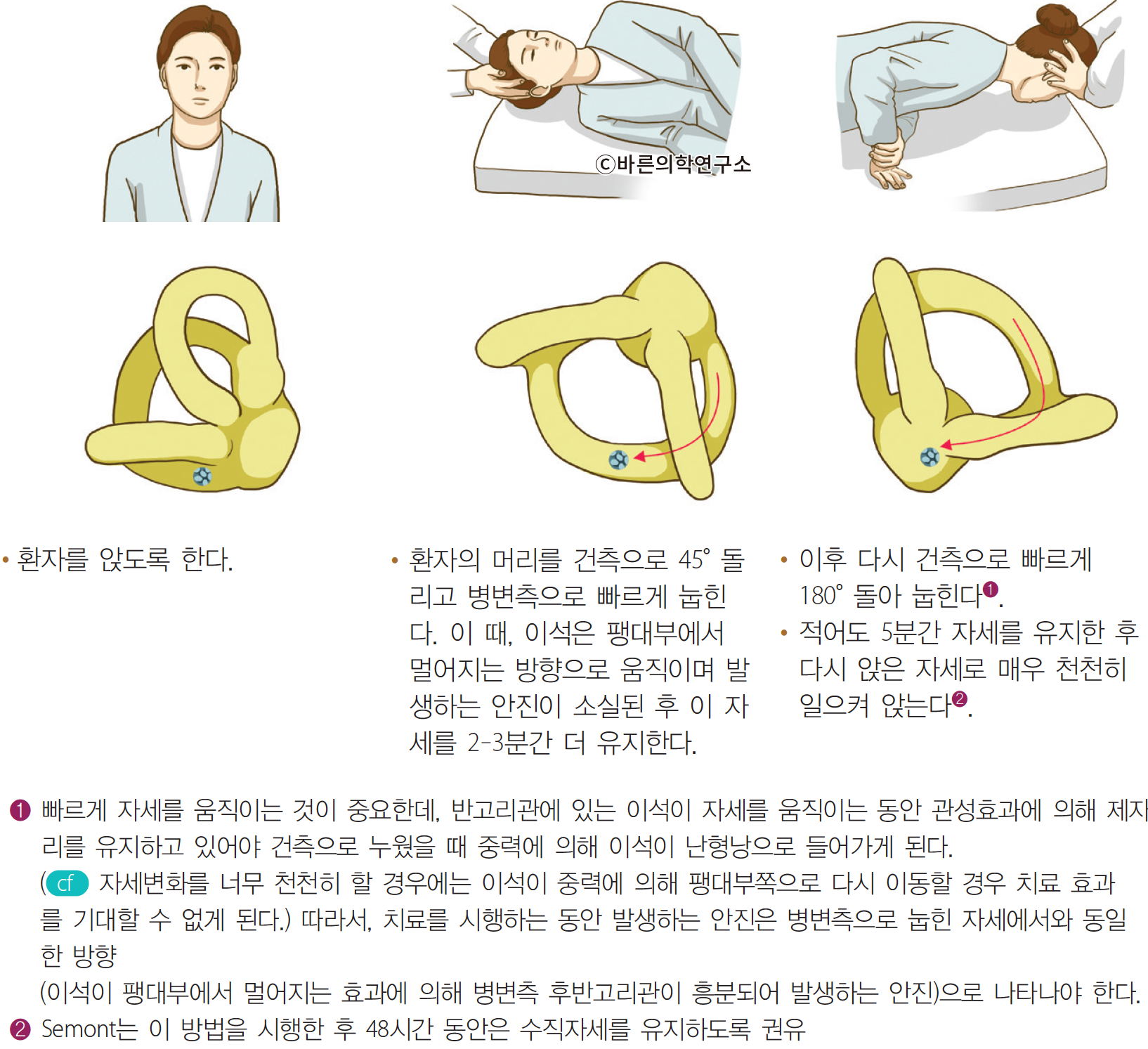 양성돌발두위현훈(Benign Paroxysmal Positional Vertigo, BPPV) - Metamedic