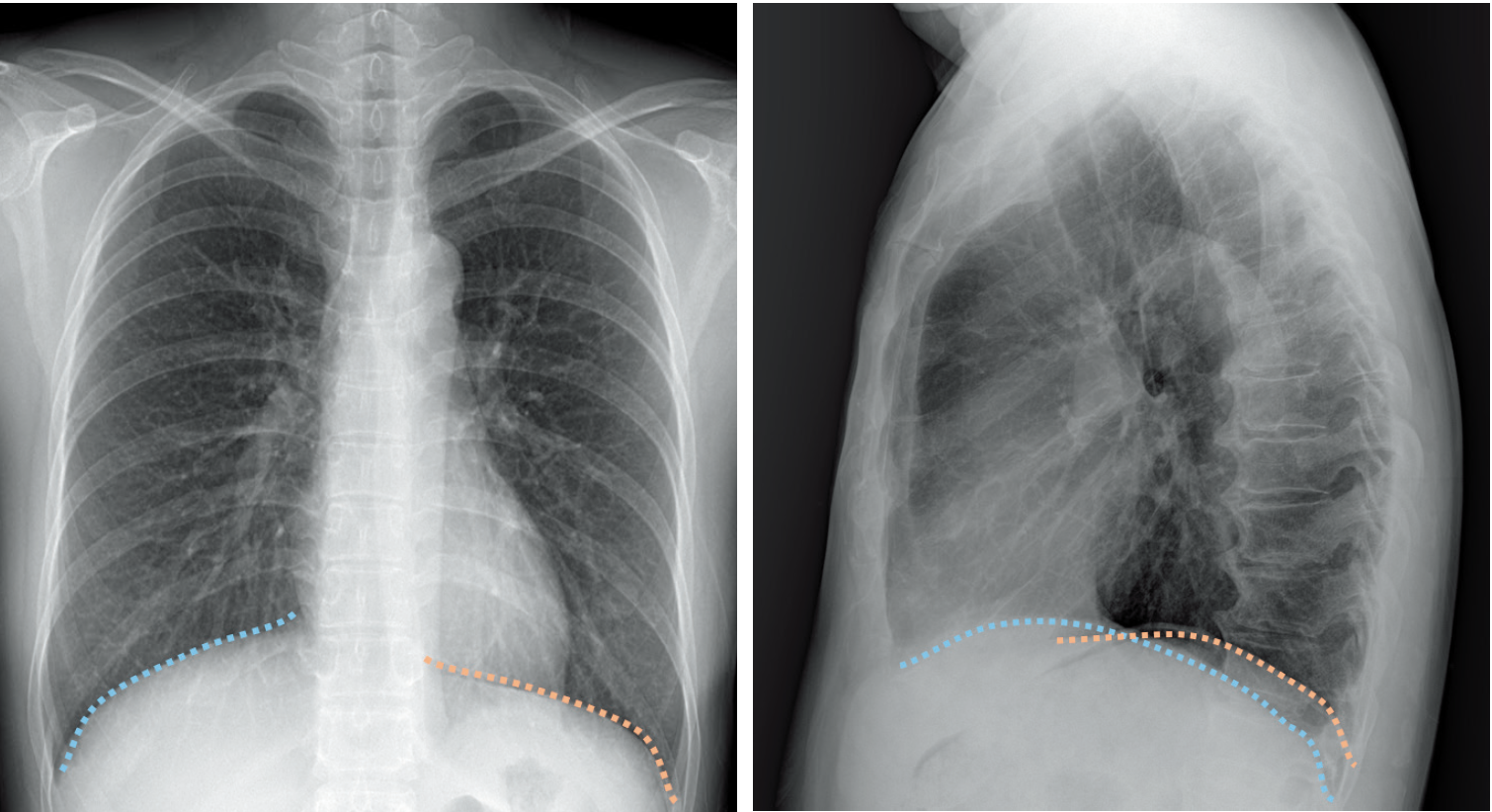 가슴 X선 - Metamedic
