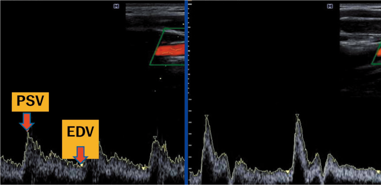 경동맥 초음파(Carotid ultrasonography) - Metamedic