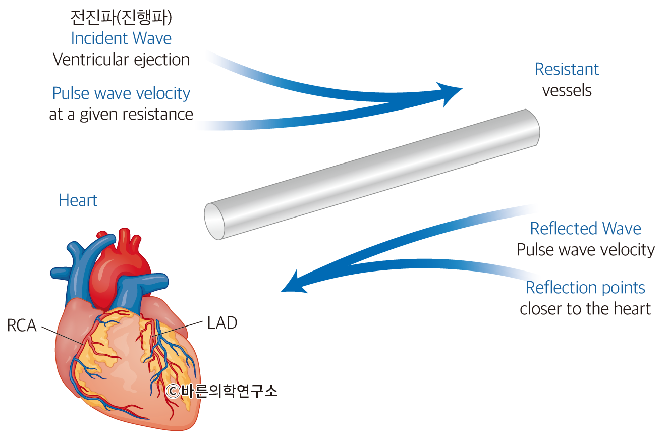 동맥경화검사(Arterial Stiffness Tests): PWV, 경동맥 내중막 두께 - Metamedic