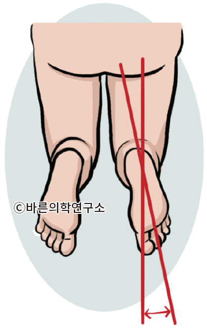 하지 변형: 염전(Torsional deformity of lower leg)/내족지보형(Intoeing gait ...