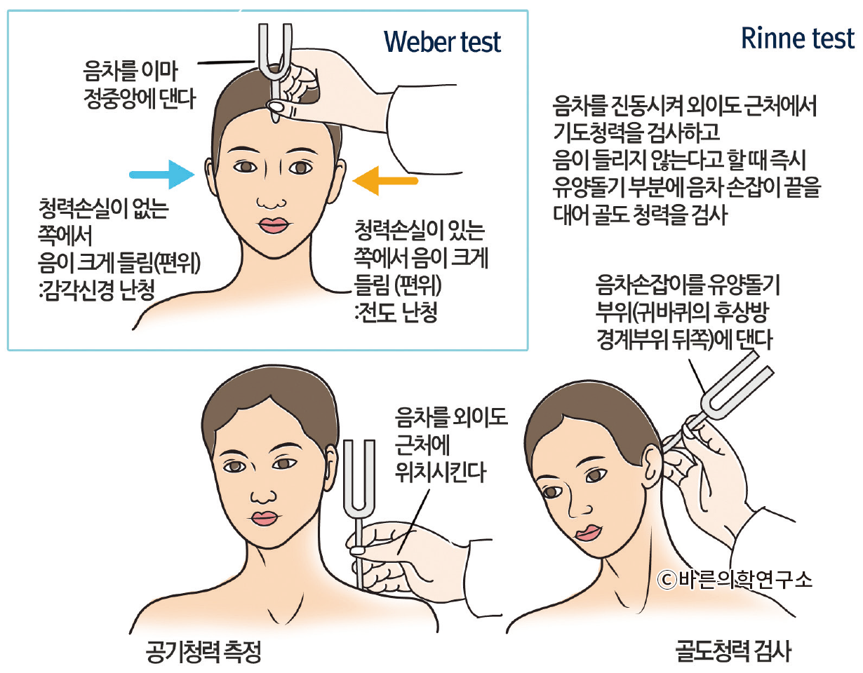 난청(Hearing loss) - Metamedic