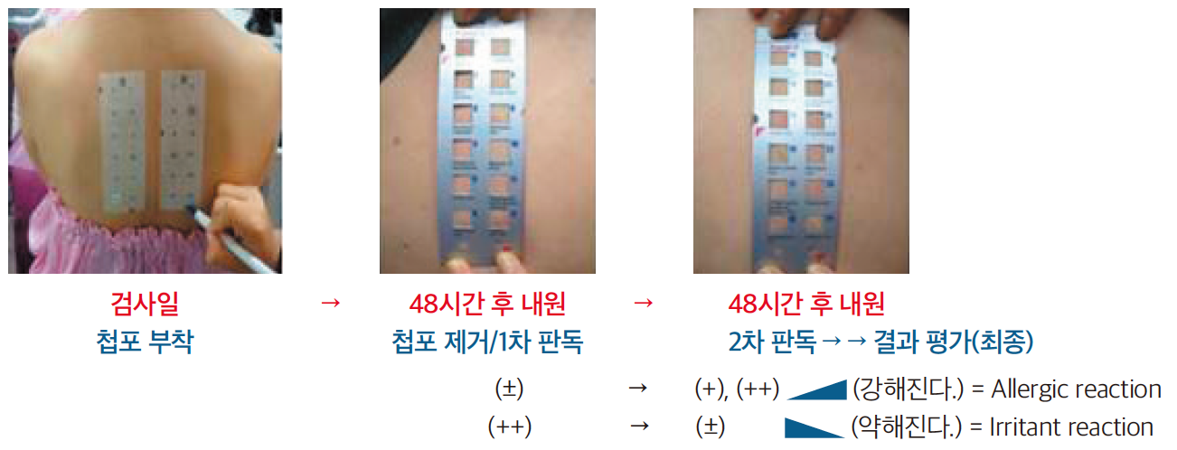 접촉 피부염(Contact dermatitis) - Metamedic
