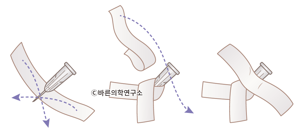 정맥로 확보: 말초정맥 주사법(Peripheral venous catheterization) - Metamedic