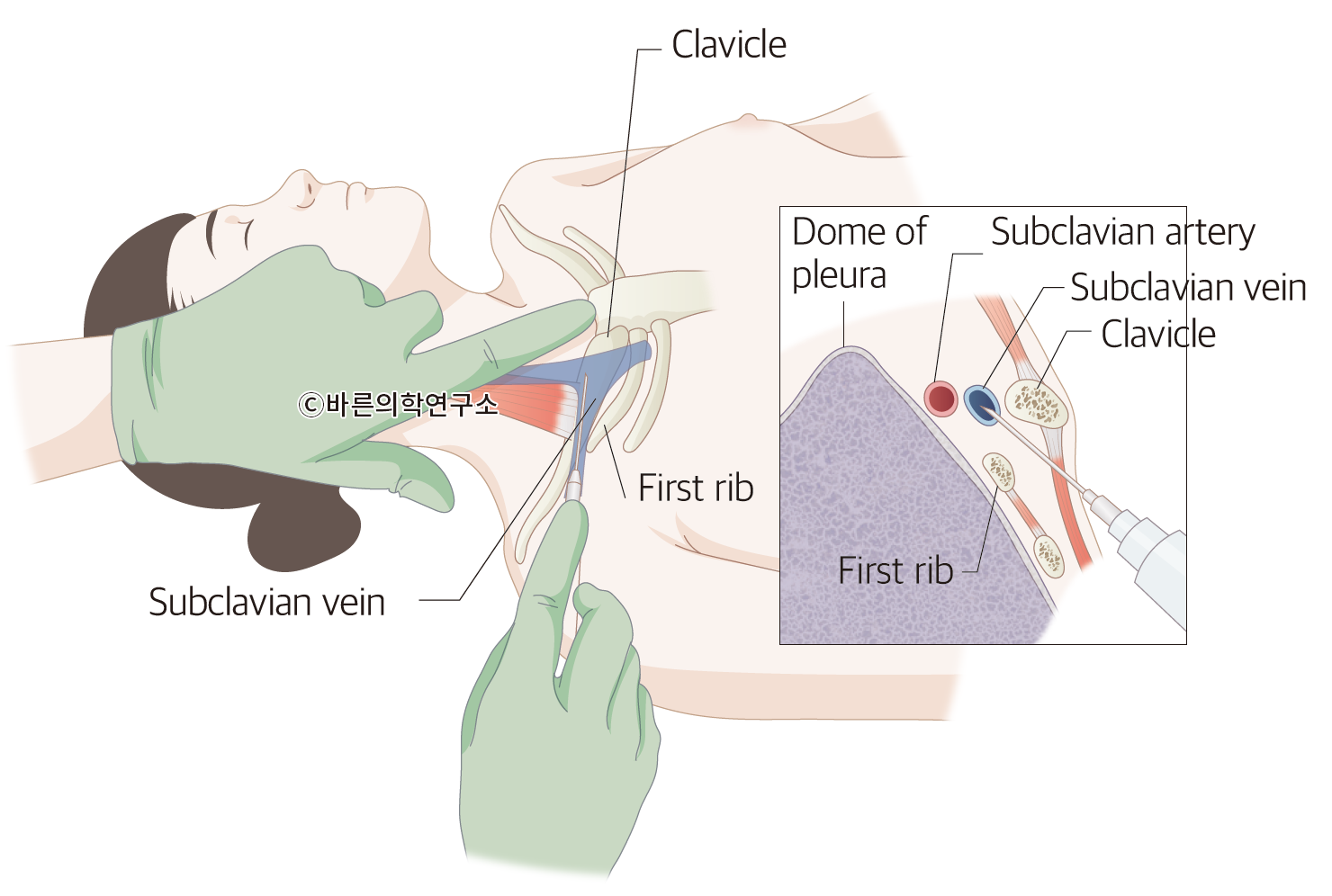 정맥로 확보: 중심정맥 주사법(Central venous catheterization, CVC) - Metamedic