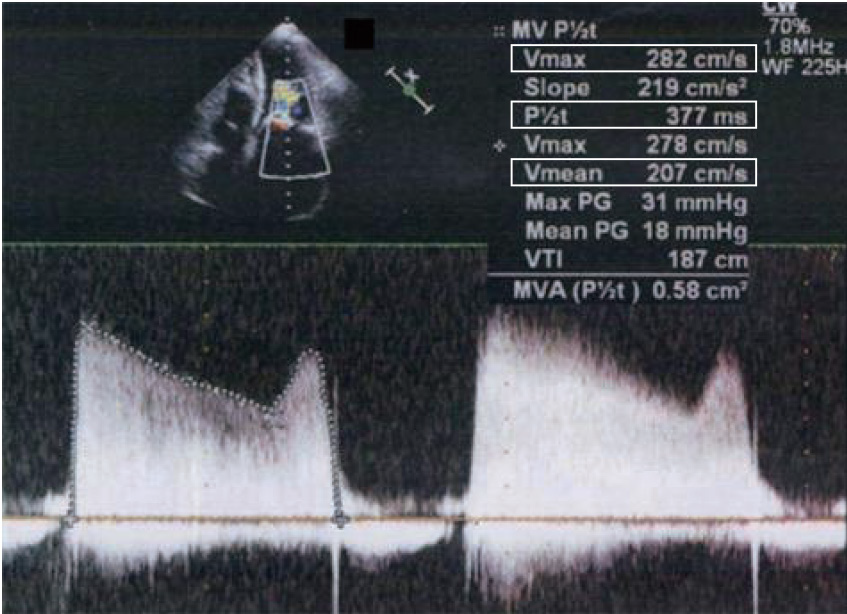 승모판 협착증(Mitral stenosis, MS) - Metamedic