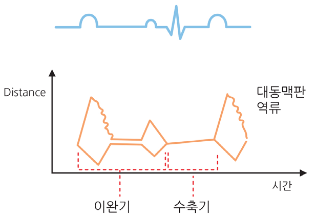 대동맥판역류증(Aortic regurgitation, AR) - Metamedic