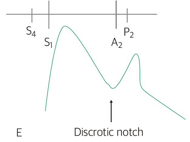 확장 심근병증(Dilated cardiomyopathy, DCM) - Metamedic