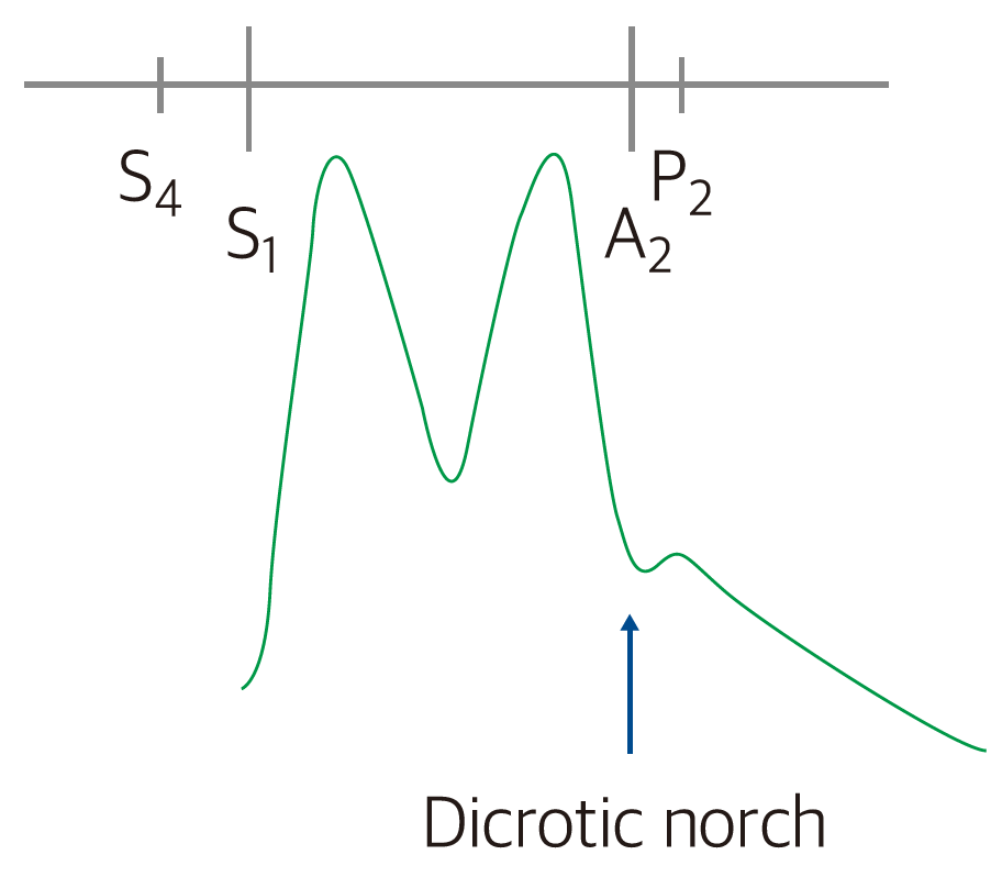 비대 심근병증(Hypertrophic cardiomyopathy, HCM) - Metamedic