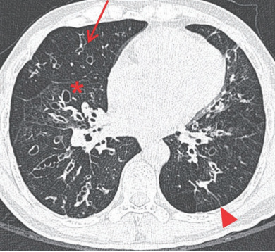 기관지확장증(Bronchiectasis): 진단 - Metamedic