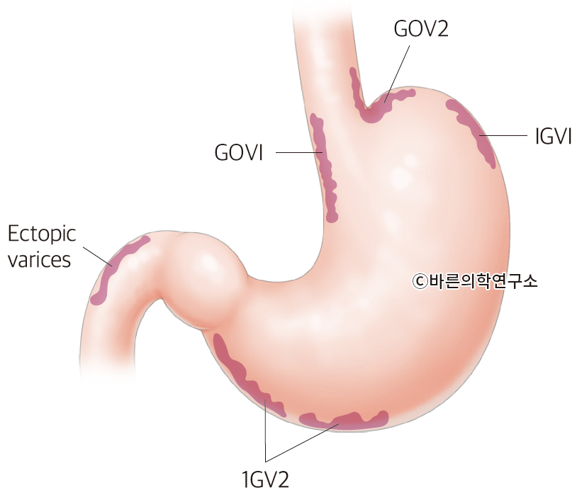 간경변증(Liver cirrhosis) 합병증: 정맥류 출혈(Variceal bleeding) - Metamedic