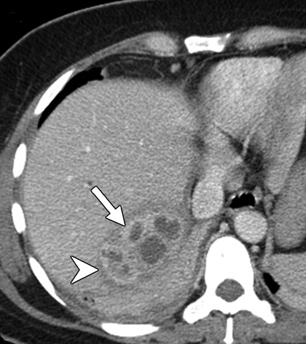 간농양(Liver abscesss) - Metamedic