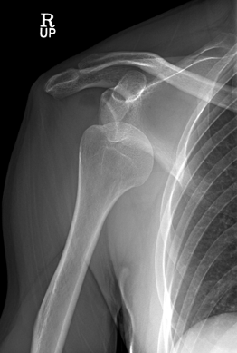 어깨탈구: 전방탈구 - Metamedic