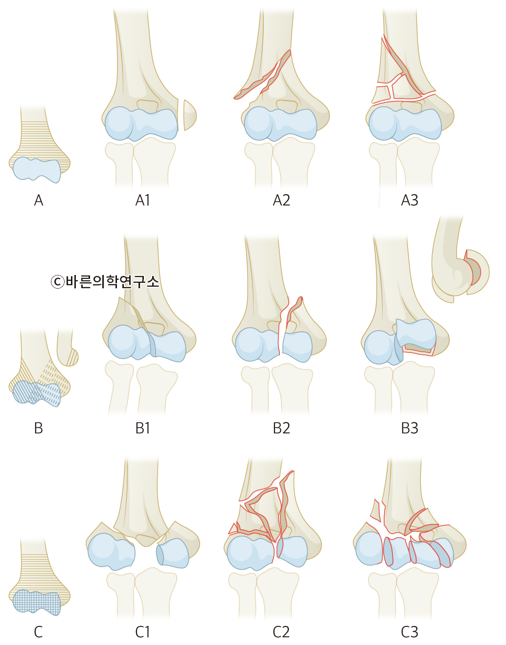 원위 상완골 골절(Distal Humeral Fractures) - Metamedic