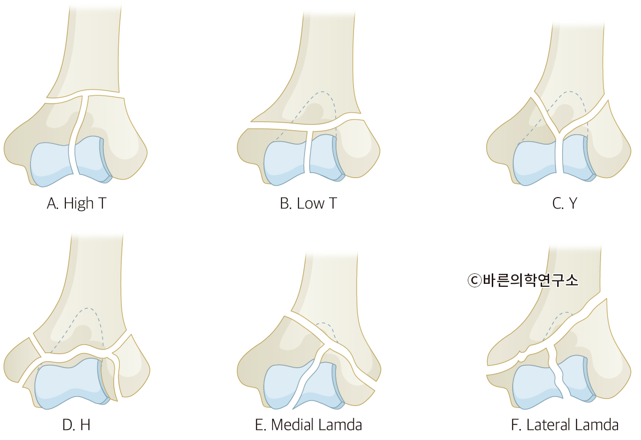 원위 상완골 골절(Distal Humeral Fractures) - Metamedic