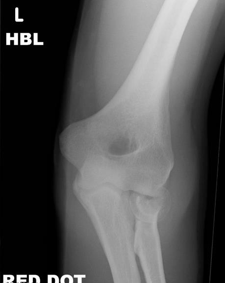 요골 두 골절(Radial head fracture) - Metamedic