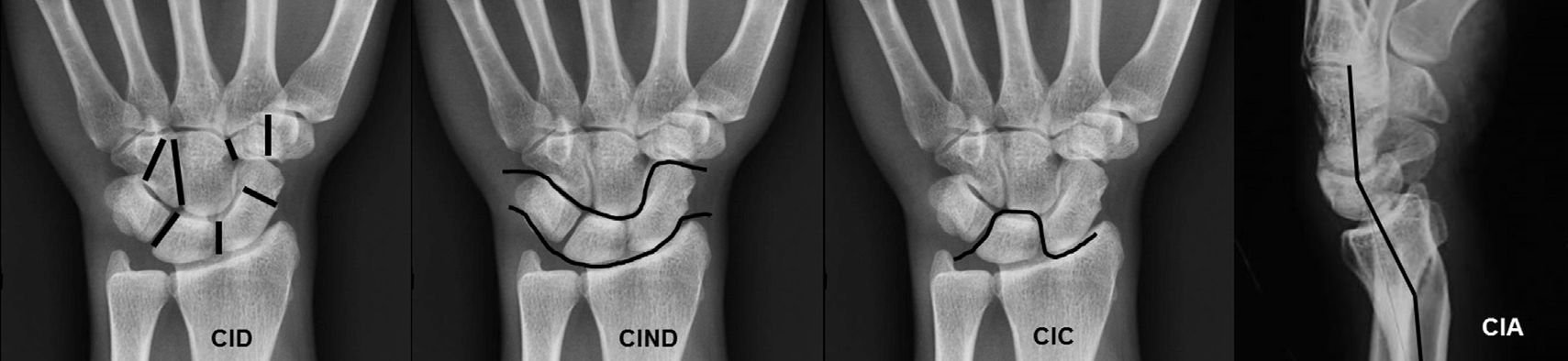 수근관절인대 손상/불안정성(Carpal Instability): 개요 - Metamedic