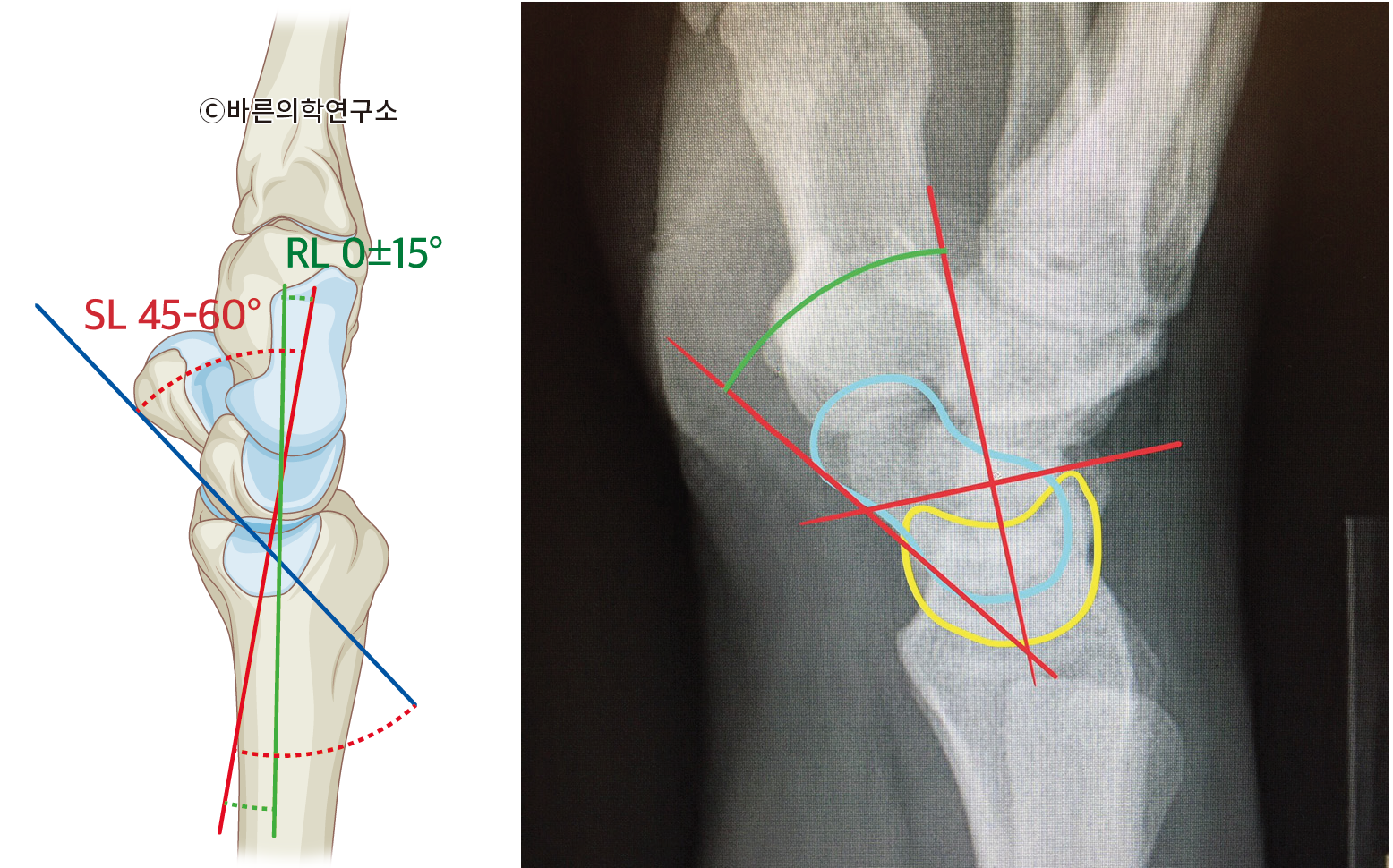 주상월상 인대 손상(Scapholunate ligament injuries) - Metamedic