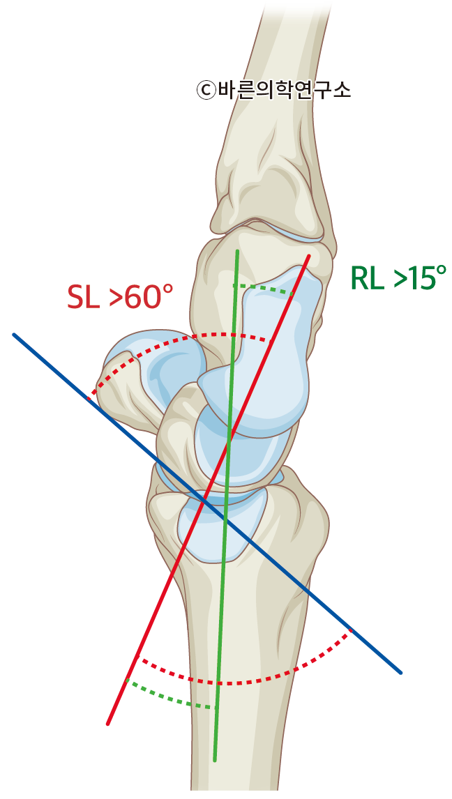 주상월상 인대 손상(Scapholunate ligament injuries) - Metamedic