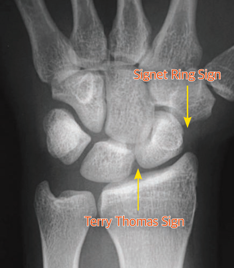 주상월상 인대 손상(Scapholunate ligament injuries) - Metamedic