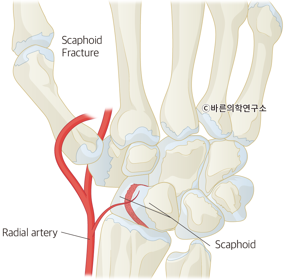 주상골 골절(Scaphoid Fracture) - Metamedic