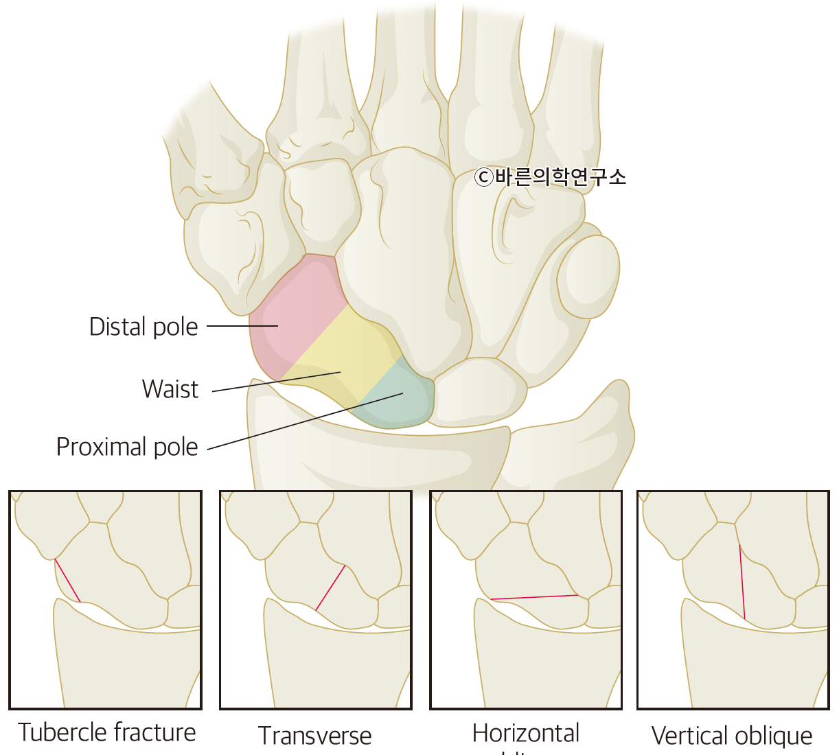 주상골 골절(Scaphoid Fracture) - Metamedic