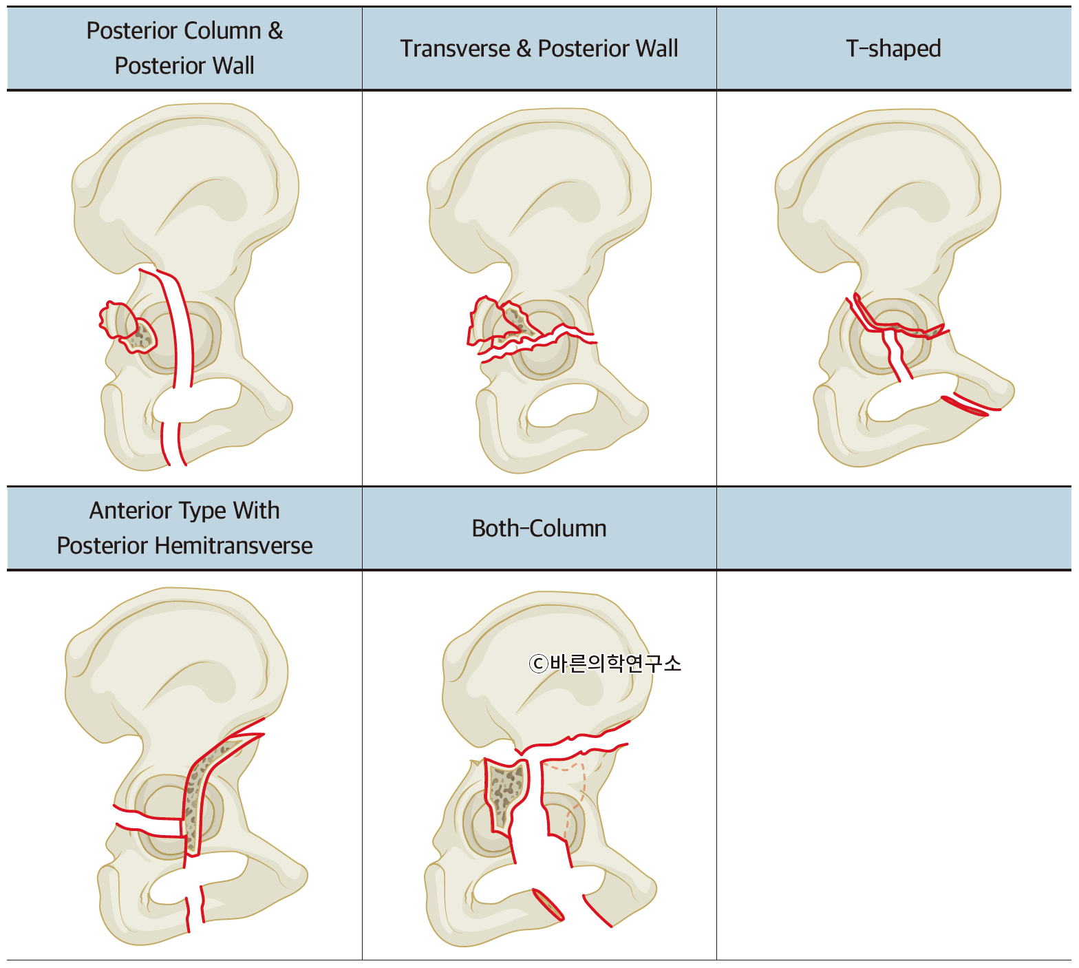 비구 골절(Acetabular Fracture) - Metamedic