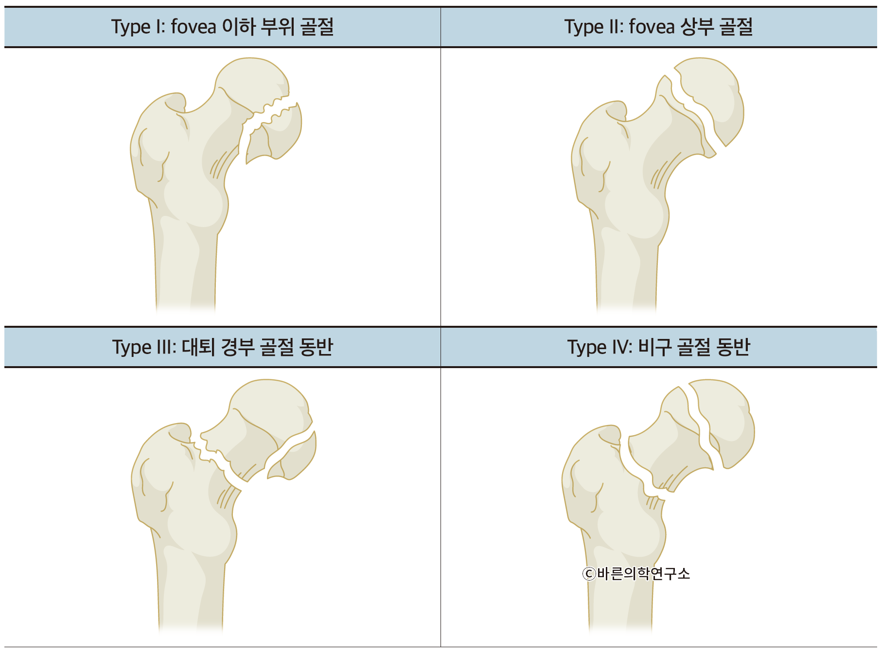 대퇴골두 골절(Femoral Head Fracture) - Metamedic