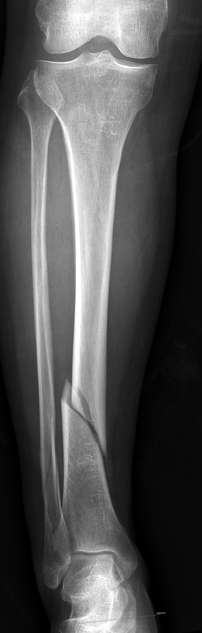 경골 간부 골절(Tibial Shaft Fracture) - Metamedic